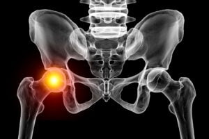 Hip Replacement Surgery | What to Expect Before, During and After